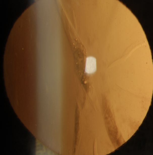 Man of Vision - Treating Cataracts - Alan Burrow Optometry